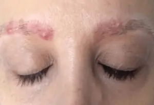 Pimple On Eyebrow Causing Swelling