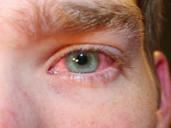 Different Types Of White Spots Under Eyelid And Home Remedies Treatment