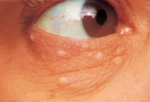 White Spots under Eyes