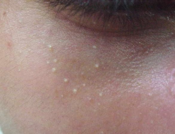 White Spots under Eyes